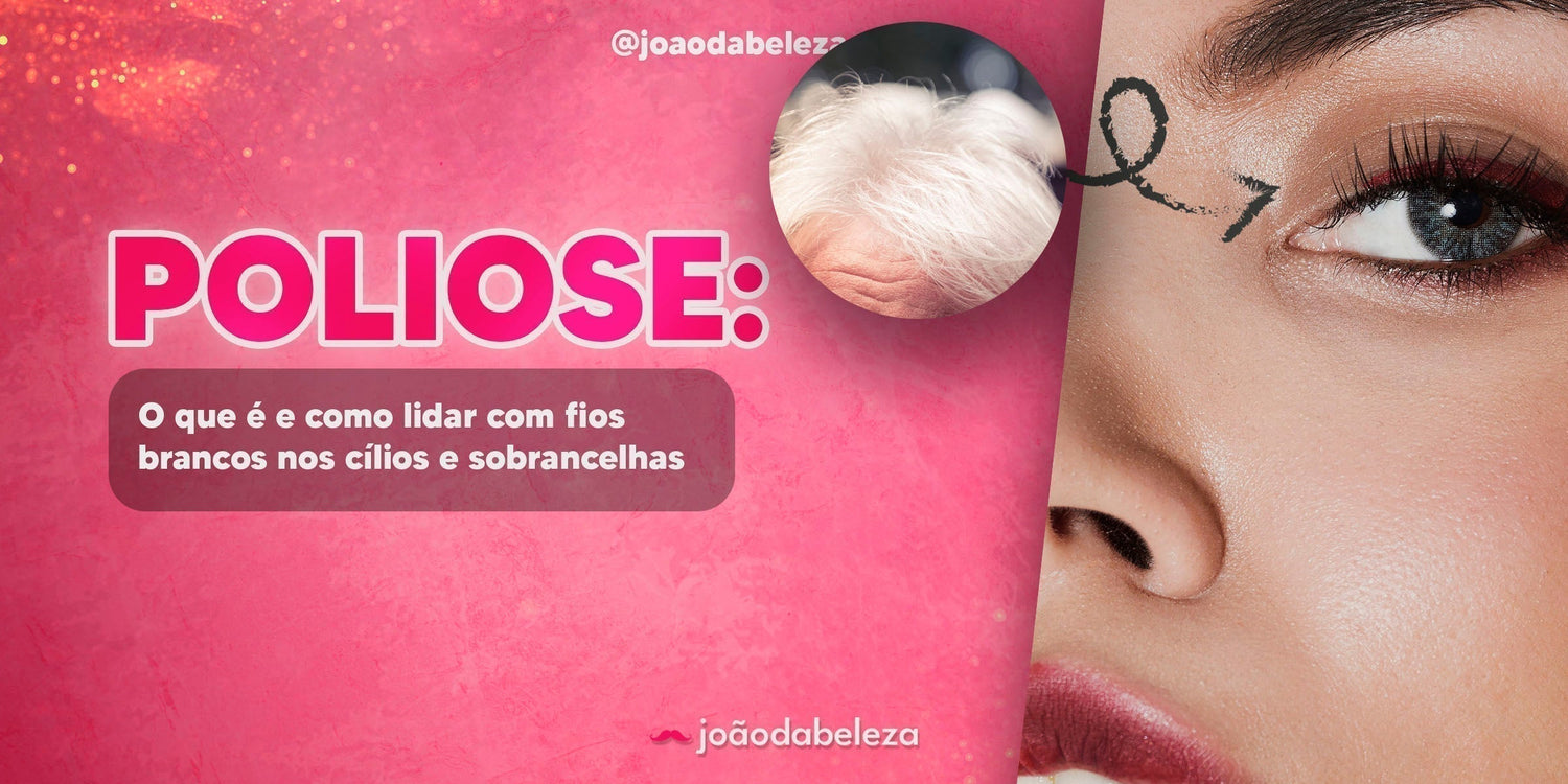 Poliose: o que é, causas, tratamentos e muito mais sobre fios brancos ...